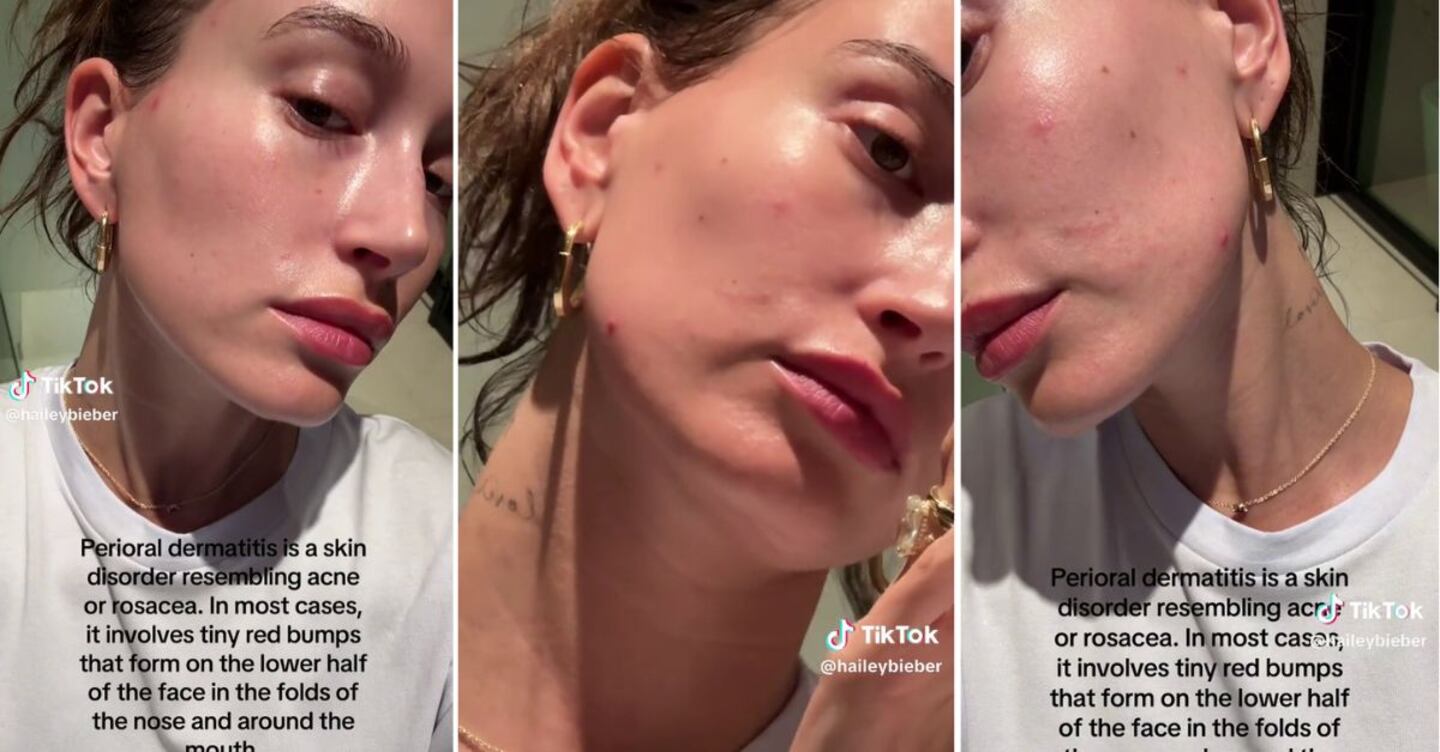 Hailey Bieber expone su rostro brotado por la dermatitis perioral ...